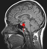 Adénome de l'hypophyse - Actualités - Sante-dz