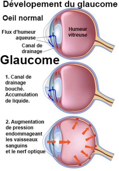 La tension de loeil - Actualités - Sante-dz