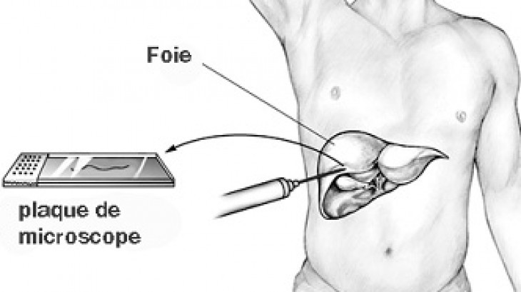Dissémination tumorale le long du trajet de ponction biopsie hépatique ...