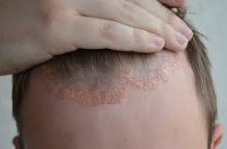 se débarrasser de la dermite séborrhéique - Conseils - Sante-dz