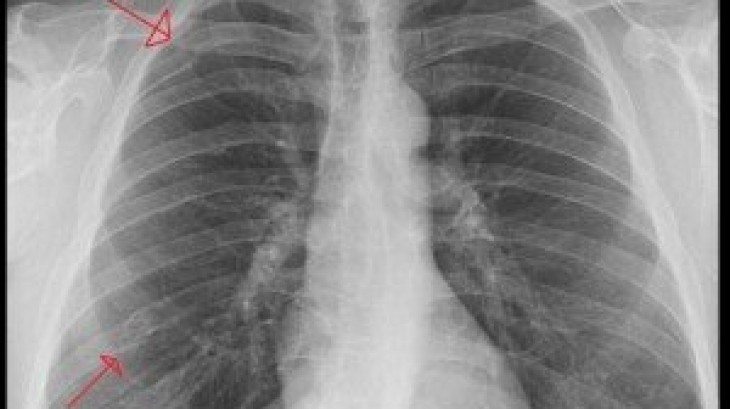 Les fractures de cote chez l´homme âgé sont un signe d´ostéoporose ...