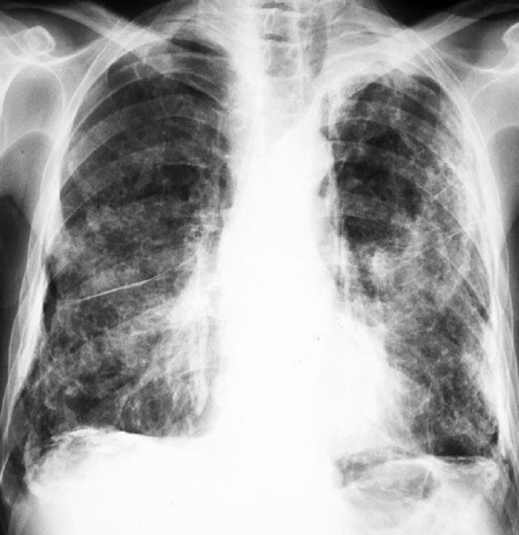 Asbestose - Actualités - Sante-dz